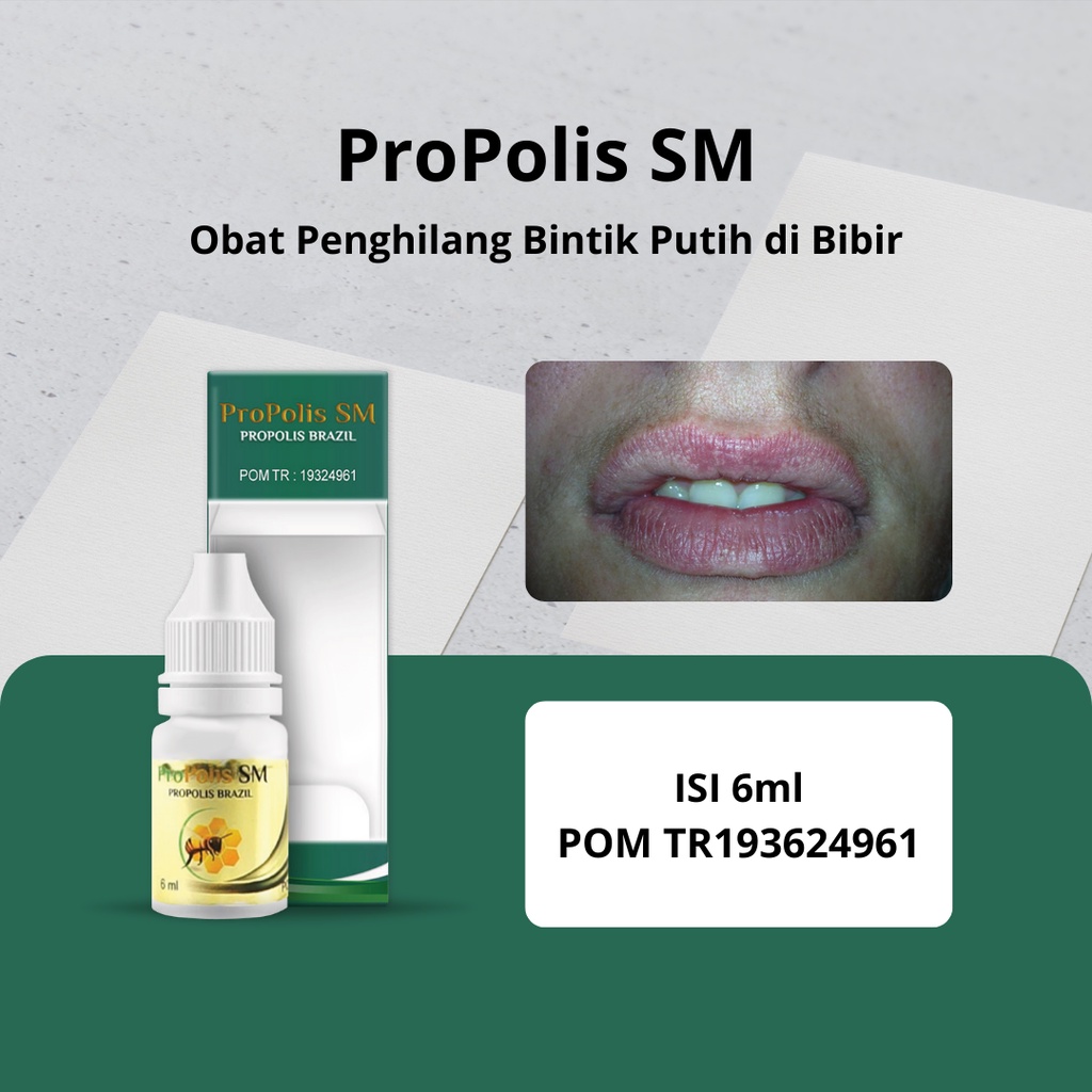 Jual Propolis SM - Obat Bintik Putih di Bibir, Penghilang Bintik Putih ...