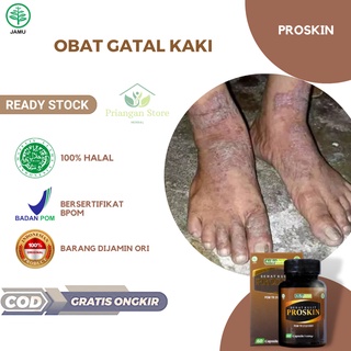 Jual Obat Gatal Kaki, Gatal Budug di Kaki, Obat Gatal Kaki Berair, Obat ...