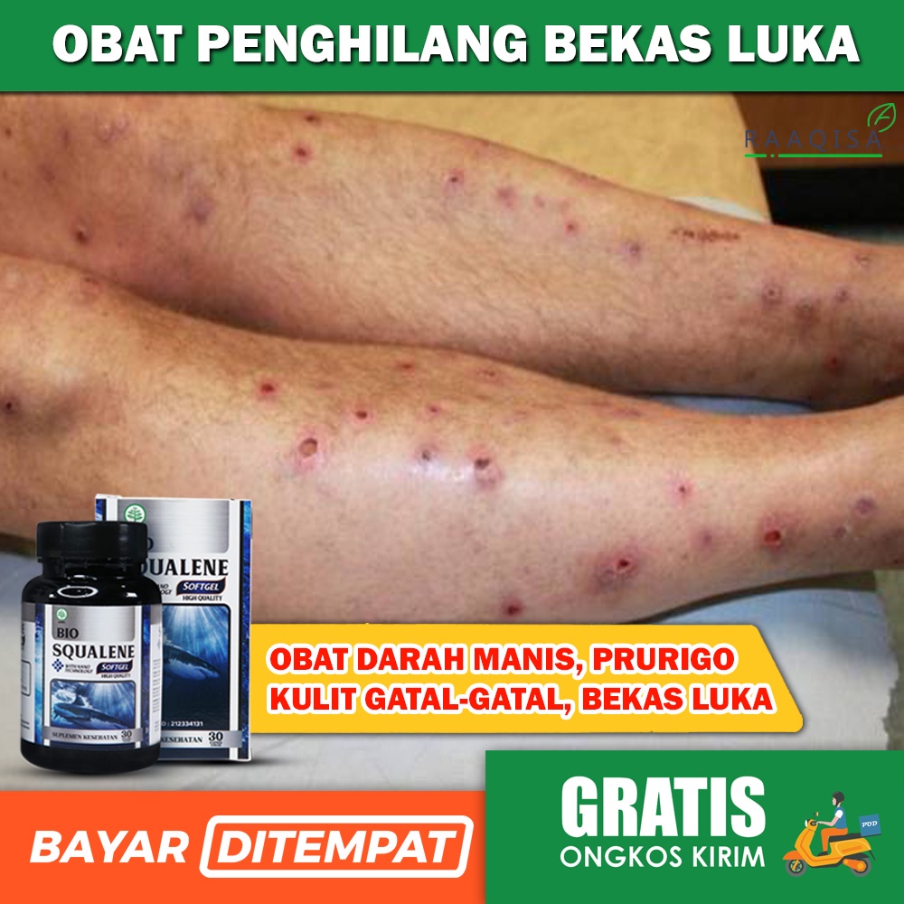 Jual Obat Darah Manis, Prurigo, Kulit Gatal-Gatal, Kulit Merah ...