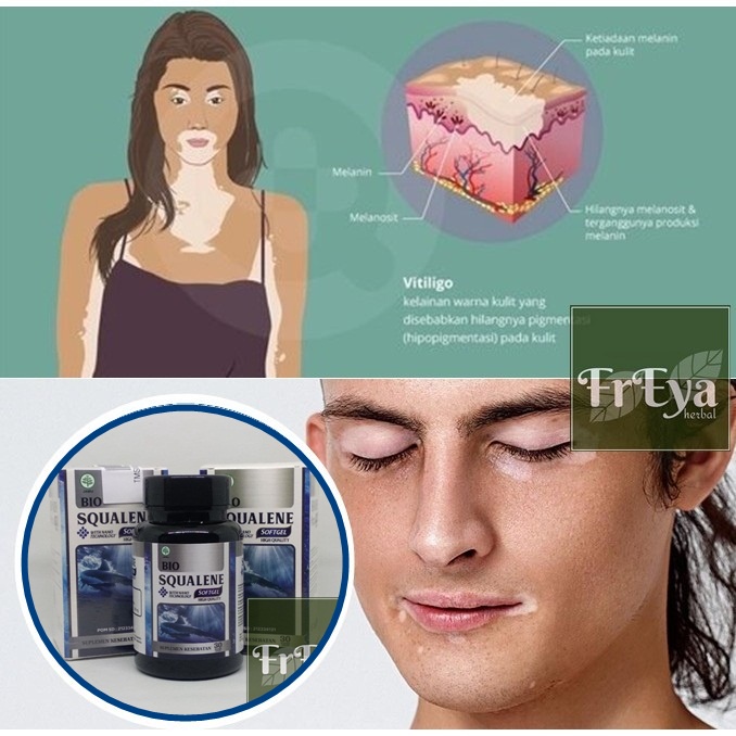 Jual OBAT VITILIGO, OBAT HERBAL COROB, OBAT WARNA KULIT MEMUDAR (BISA ...