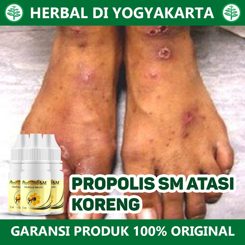 Jual Obat Korengan, Atasi Korengan Di Kaki, Luka Bekas Koreng Propolis ...