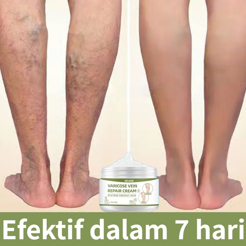 Jual Krim varises vena, pengobatan varises, vaskulitis, krim perawatan ...