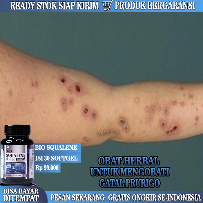 Jual Obat Prurigo, Obat Prurigo Darah Manis, Obat Koreng Darah Manis ...
