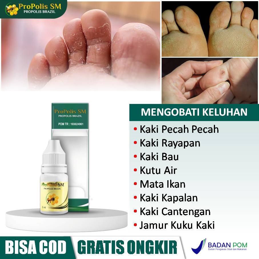 Jual Obat Kaki Pecah Pecah Dan Kering, Kaki Rayapan, Kaki Bau, Kutu Air ...