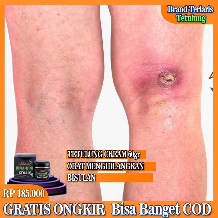 Jual Tetulung Cream 60gr, Cream Untuk Bisulan, Cream Untuk Bisul Bernanah, Cream Untuk Bisul ...