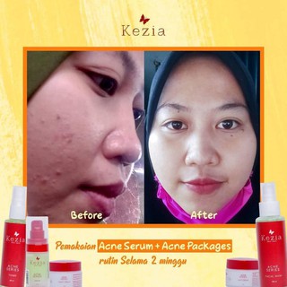 Jual [Original] Kezia Skincare Acne Series Package Paket Kezia | Shopee Indonesia
