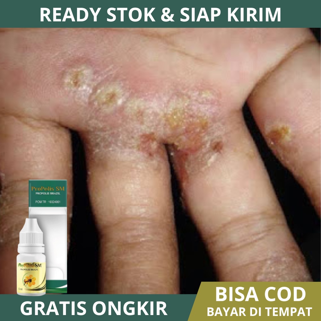 Jual Obat Budug, Obat Budug Gatal, Obat Budug Santri, Obat Budugan ...
