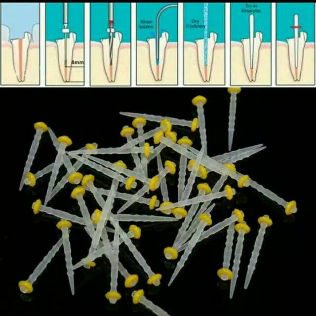 Jual Pasak fiber post / fiber post / post core Indonesia|Shopee Indonesia