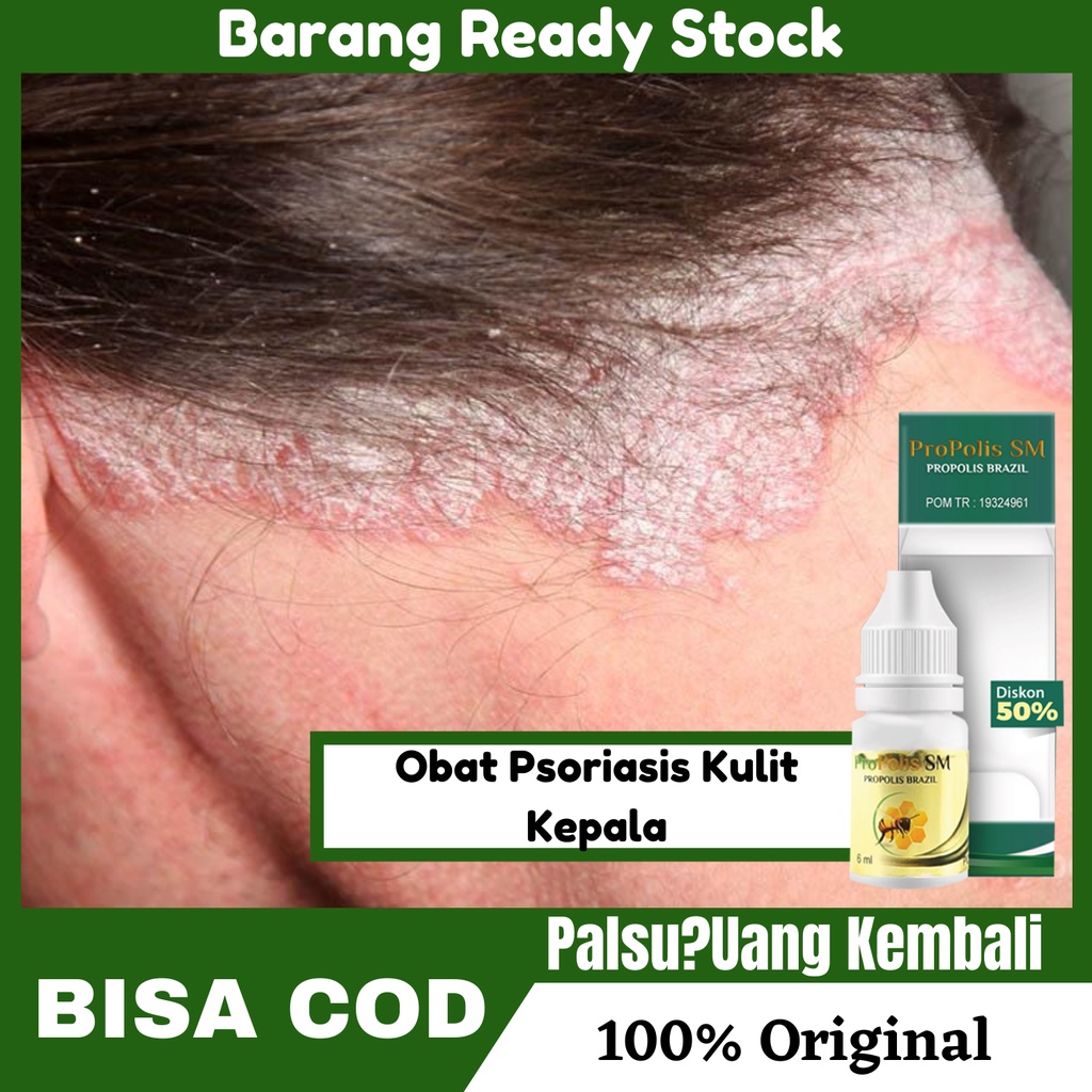 Jual Obat Psoriasis Kulit Kepala , Kulit Bersisik , Kulit Kepala Kering ...