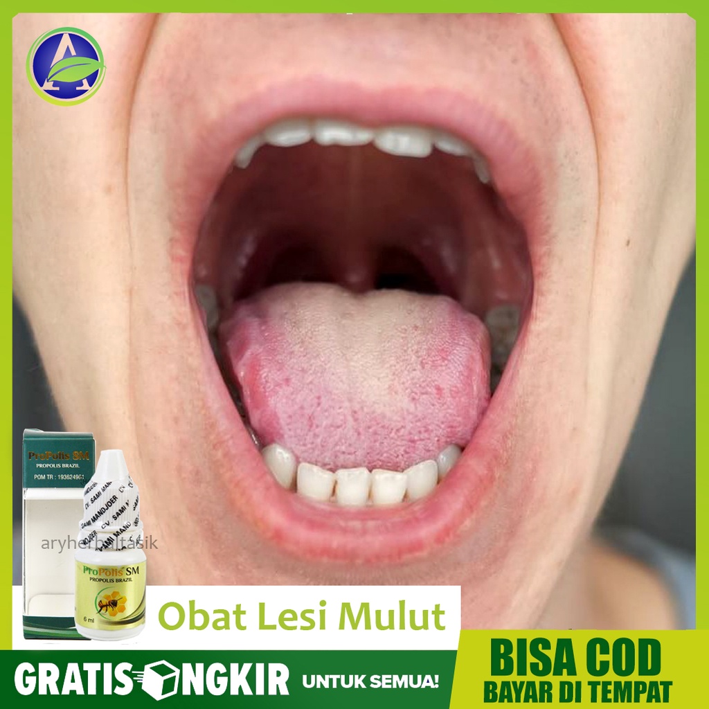 Jual Obat Luka di Rongga Mulut Lesi Mulut Bibir Pecah-Pecah Benjolan di ...