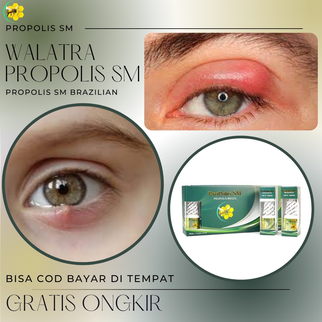 Jual Obat Penghilang Benjolan Di Mata, Kalazion, Obat Bintitan ...