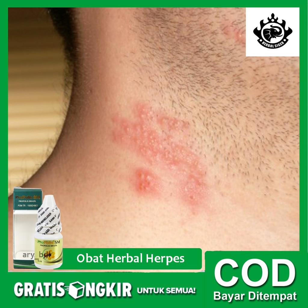 Jual Obat Herbal Herpes, Herpes Zoster, Ruam Merah di Kulit, Gudikan ...