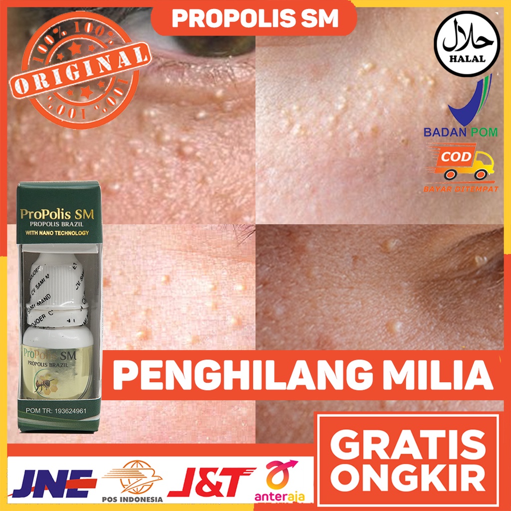 Jual Obat Pengilang Milia - Obat Milia di Wajah - Obat Milia di Bawah ...