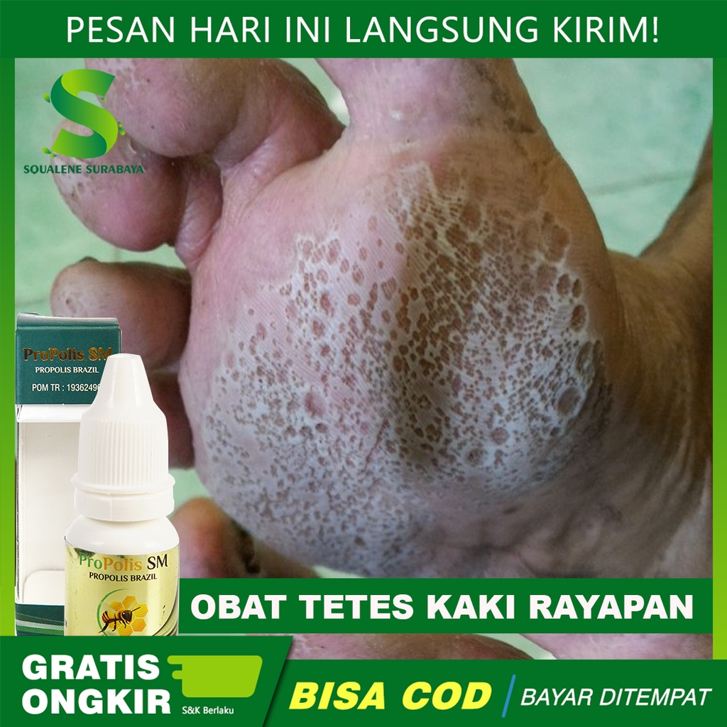 Jual Obat Tetes Kaki Rayapan - Obat Telapak Kaki Bolong Bolong - Kaki ...