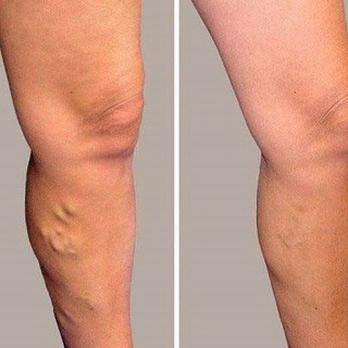 Jual VARIKOSE 100% ASLI VARIKOSE ORIGINAL CREAM ATASI VARISES - STRECK ...