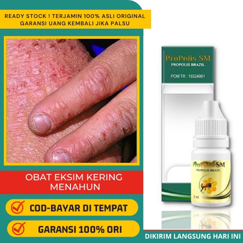 Jual Obat Eksim Kering Alami - Obat Tradisional Penyakit Kulit Menahun ... Jual Obat Eksim Kering Alami - Obat Tradisional Penyakit Kulit Menahun ...