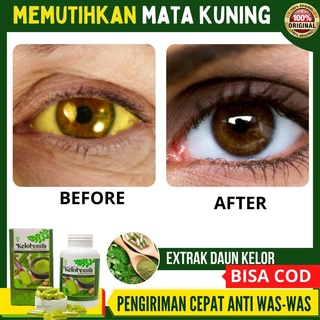 Jual Cara Memutihkan Mata Kuning Secara Alami, Obat Mata Kuning di ...