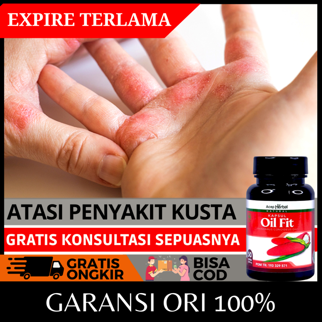 Jual Obat Kusta Herbal Penyakit Lepra Basah dan Kering Infeksi Bakteri ...