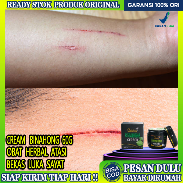 Jual Obat Luka Sayat,Obat Gatal Kulit Untuk Bekas Luka,Cream Binahong ...