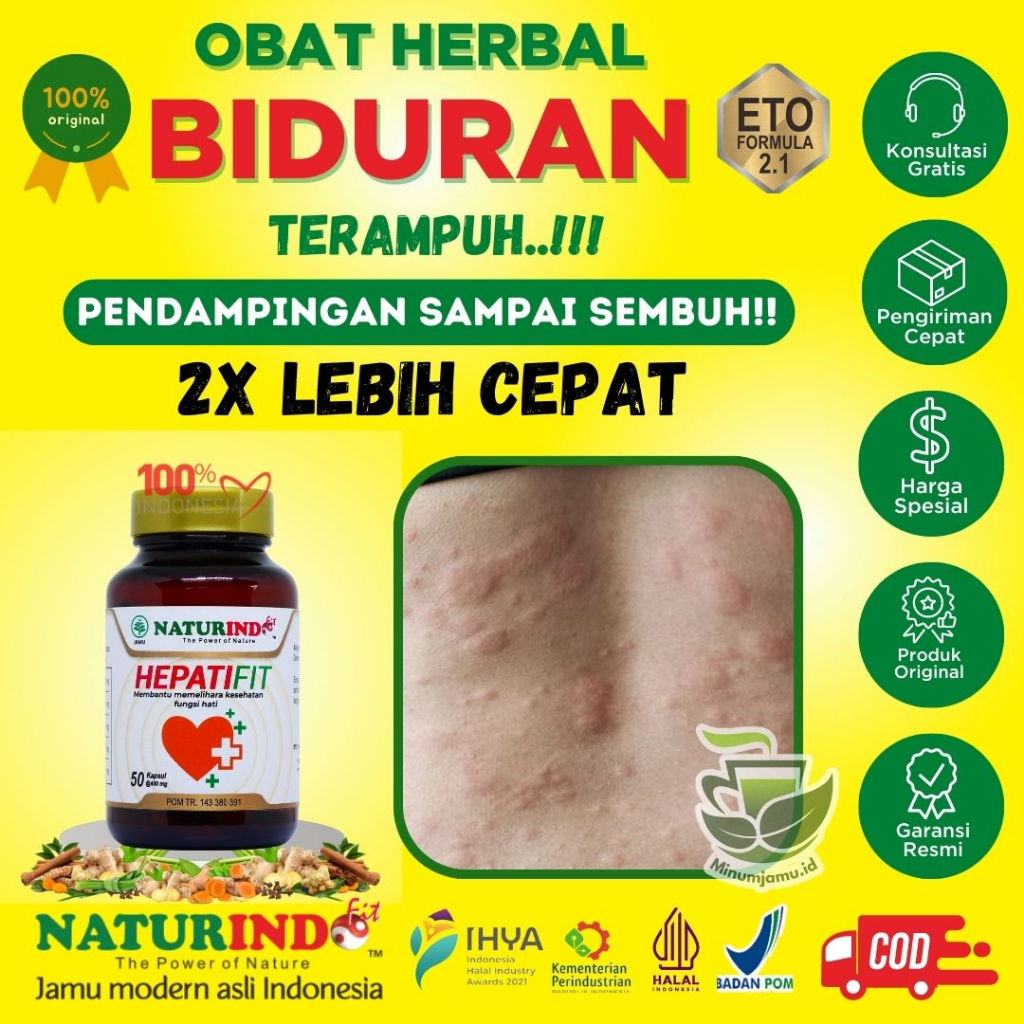 Jual Obat Gatal Kulit Alergi Dingin Biduran Gatal Alergi Herbal Bentol ...