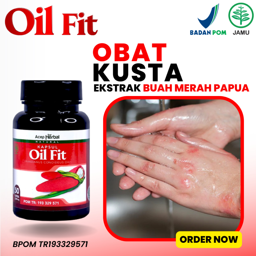Jual Obat Kusta Basah dan Kering Penyakit Kulit Lepra Morbus Hansen ...