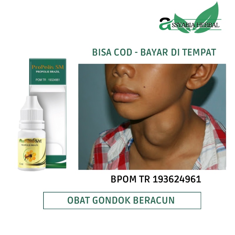 Jual Obat Gondok Beracun, Gondok di Leher, Tiroid Bengkak, Kelenjar ...