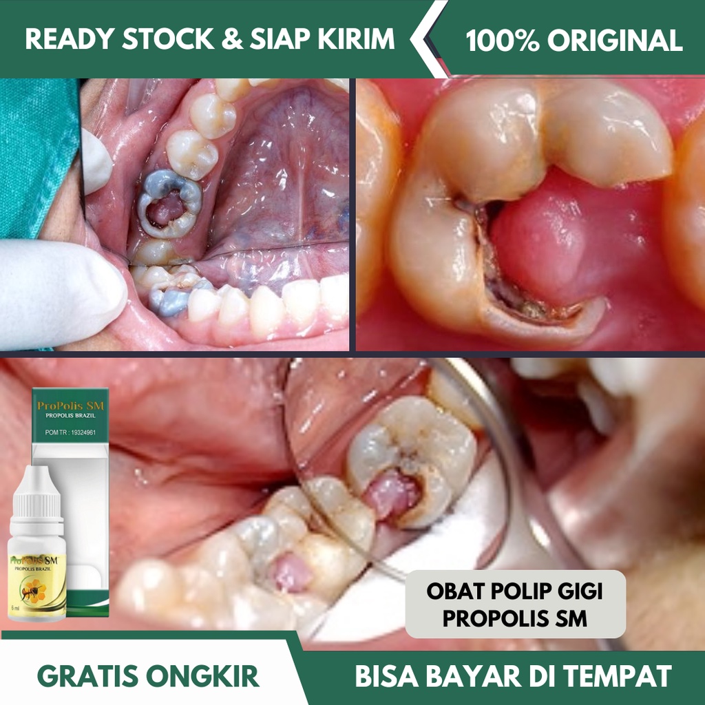 Jual Obat Polip Gigi, Polip Pulpa Gigi, Sakit Gigi dan Gusi Bengkak Herbal - Propolis SM ...