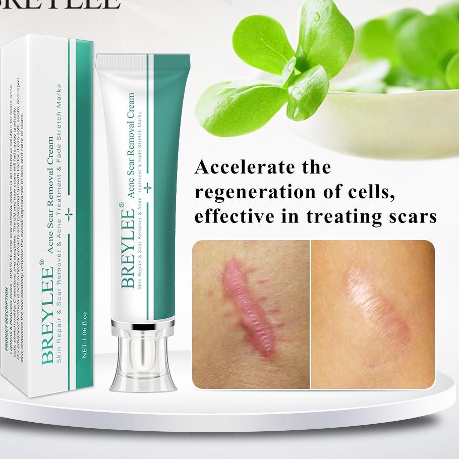 Jual Real produk--BREYLEE Acne Scar Removal Cream Skin Repair Scar Acne Treatment Remove ...