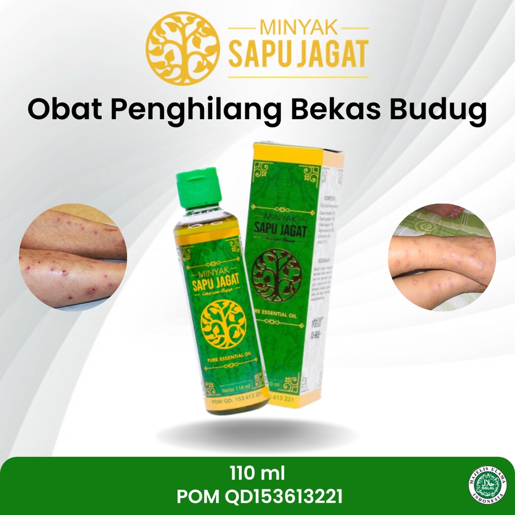 Jual Sapnu Herbal - Obat Penghilang Bekas Budug, Budug Di Kaki, Budug ...