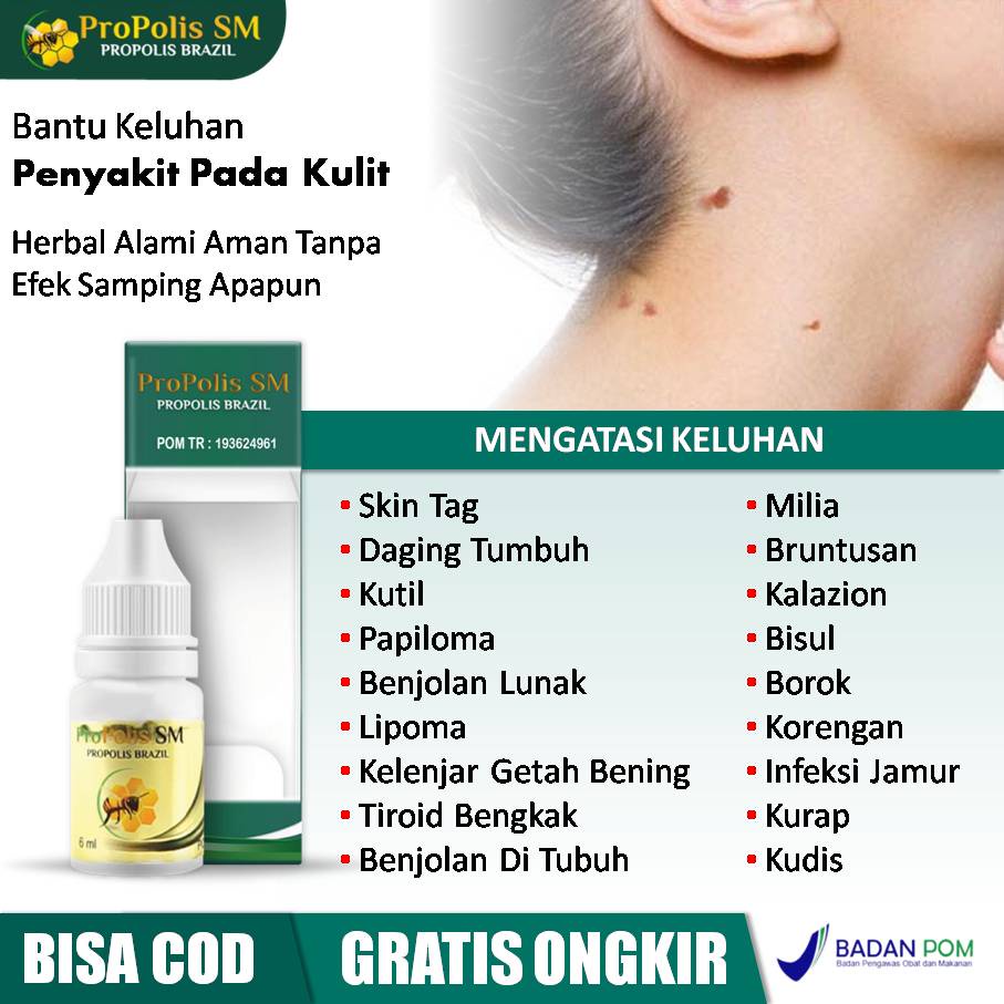 Jual Obat Skin Tag Di Leher, Daging Tumbuh Di Kulit, Kutil, Papiloma ...