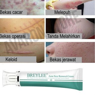 Jual Real produk--BREYLEE Acne Scar Removal Cream Skin Repair Scar Acne Treatment Remove ...