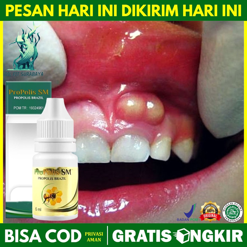 Jual Obat Tetes Abses Gusi - Obat Tetes Polip Gusi - Obat Gusi Bernanah ...