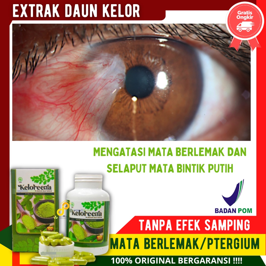 Mata Terasa Sakit Saat Berkedip - Perumperindo.co.id