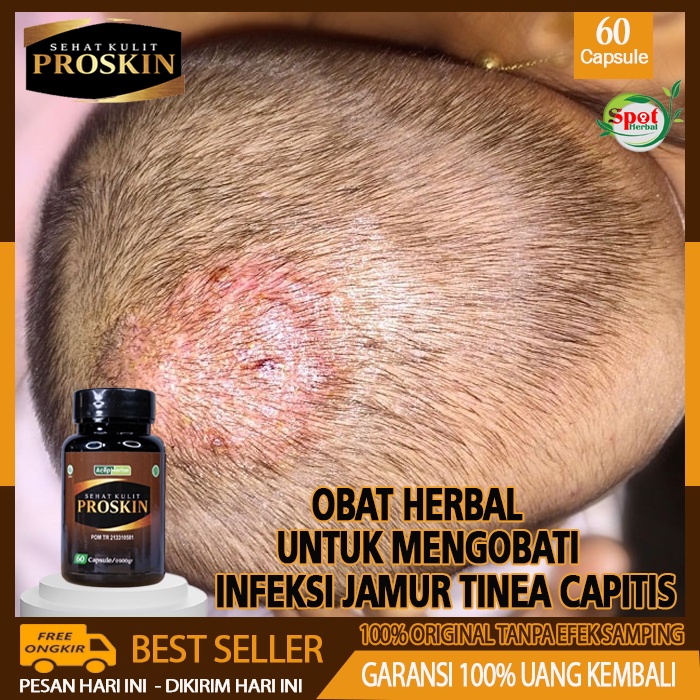 Jual Obat Infeksi Jamur Kulit Tinea Capitis, Obat Gatal Kurap Kepala, Obat Kurap Berkerak, Obat ...