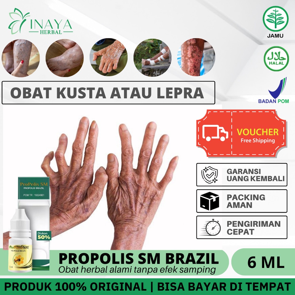 Jual Obat Herbal Penyakit Kusta - Obat Kusta Lepra - Obat Kusta Kering ...