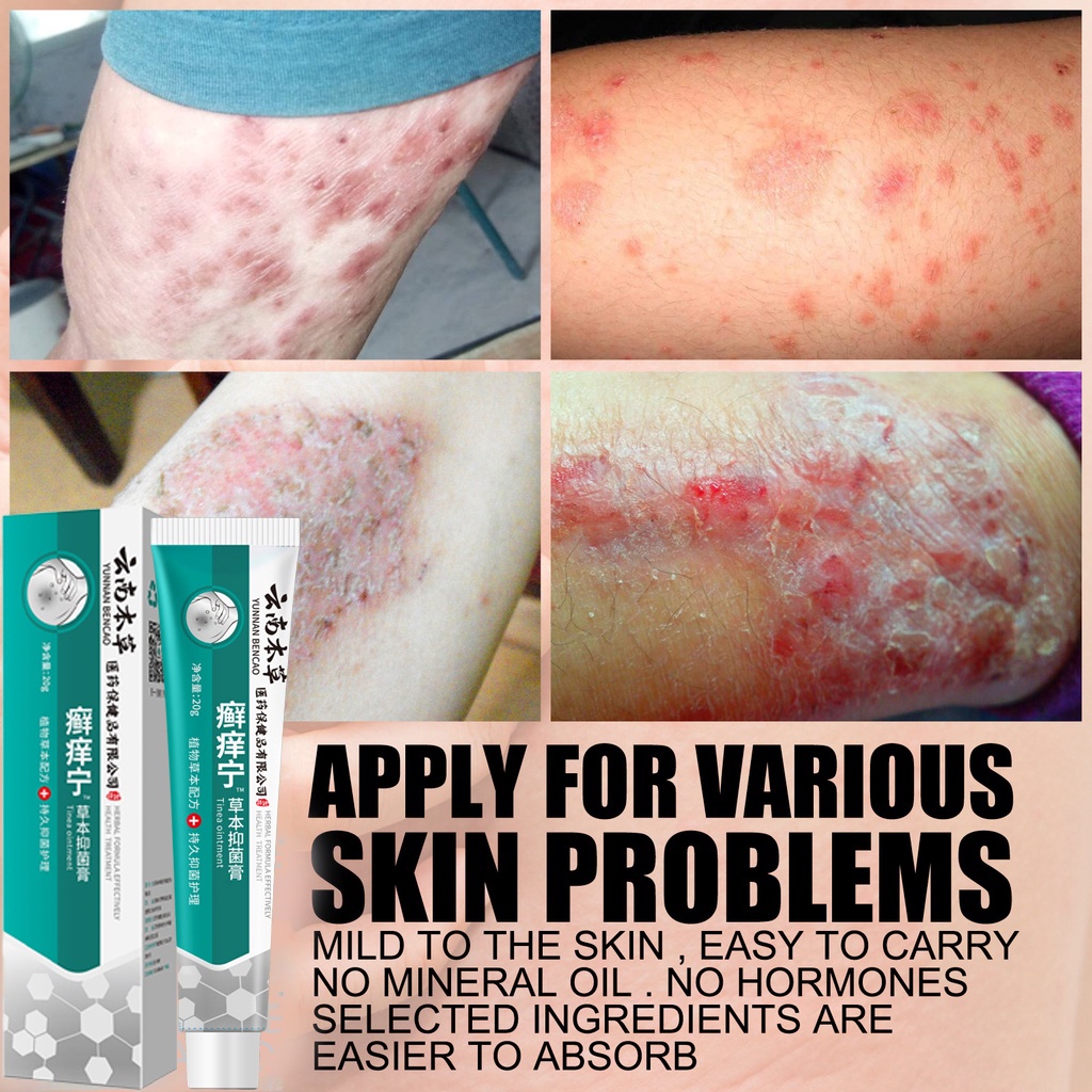 Jual Salep gatal Salep Eksim Salep kulit Krim psoriasis paling ampuh ...