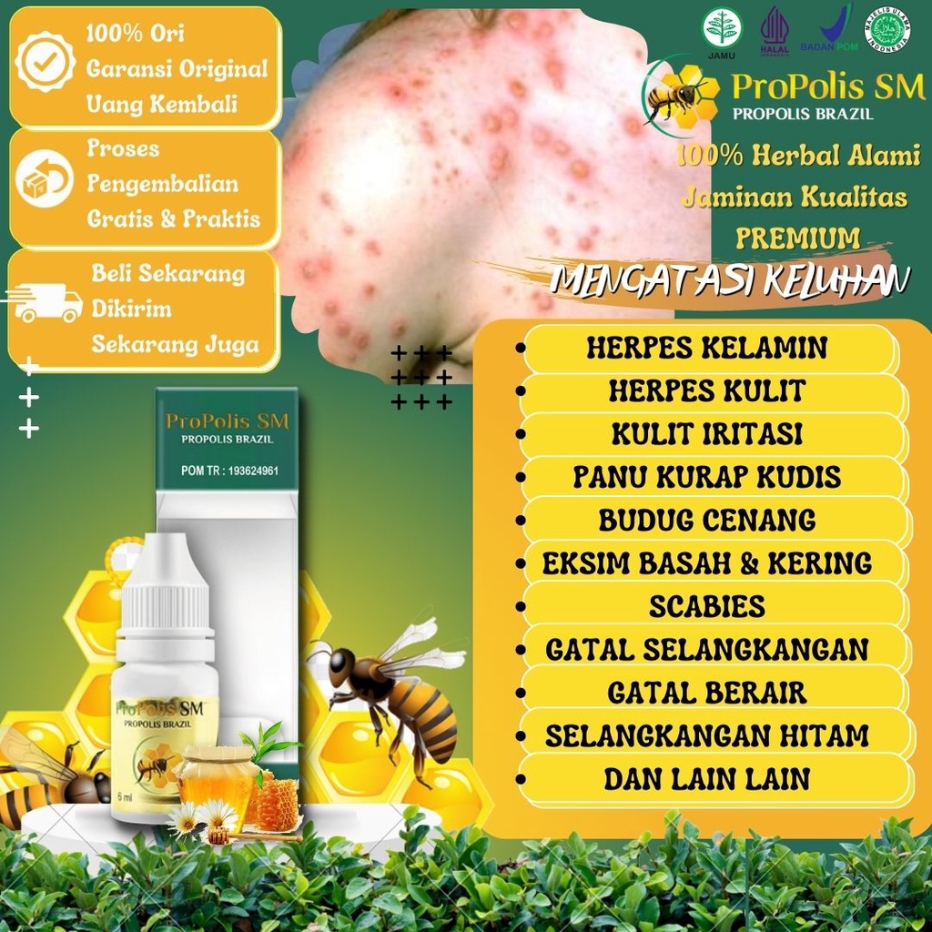 Jual Obat Herpes Kulit Herpes Kelamin Eksim Basah Kering Cacar Air ...