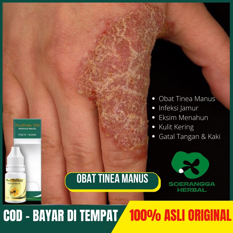 Jual Obat Tinea Manus, Infeksi Jamur, Eksim Menahun, Kulit Kering ...