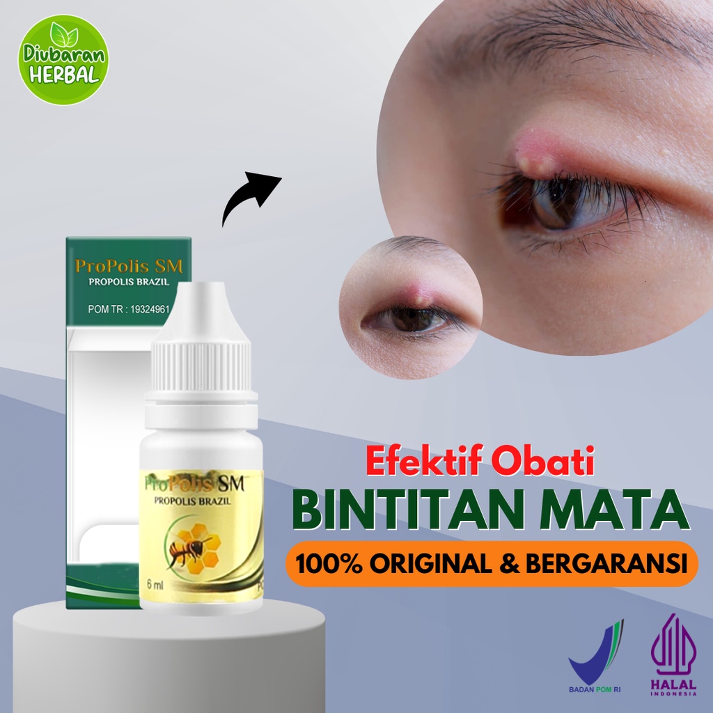 Jual Obat Mata Bintitan - Kalazion - Benjolan Kelopak Mata Propolis SM ...