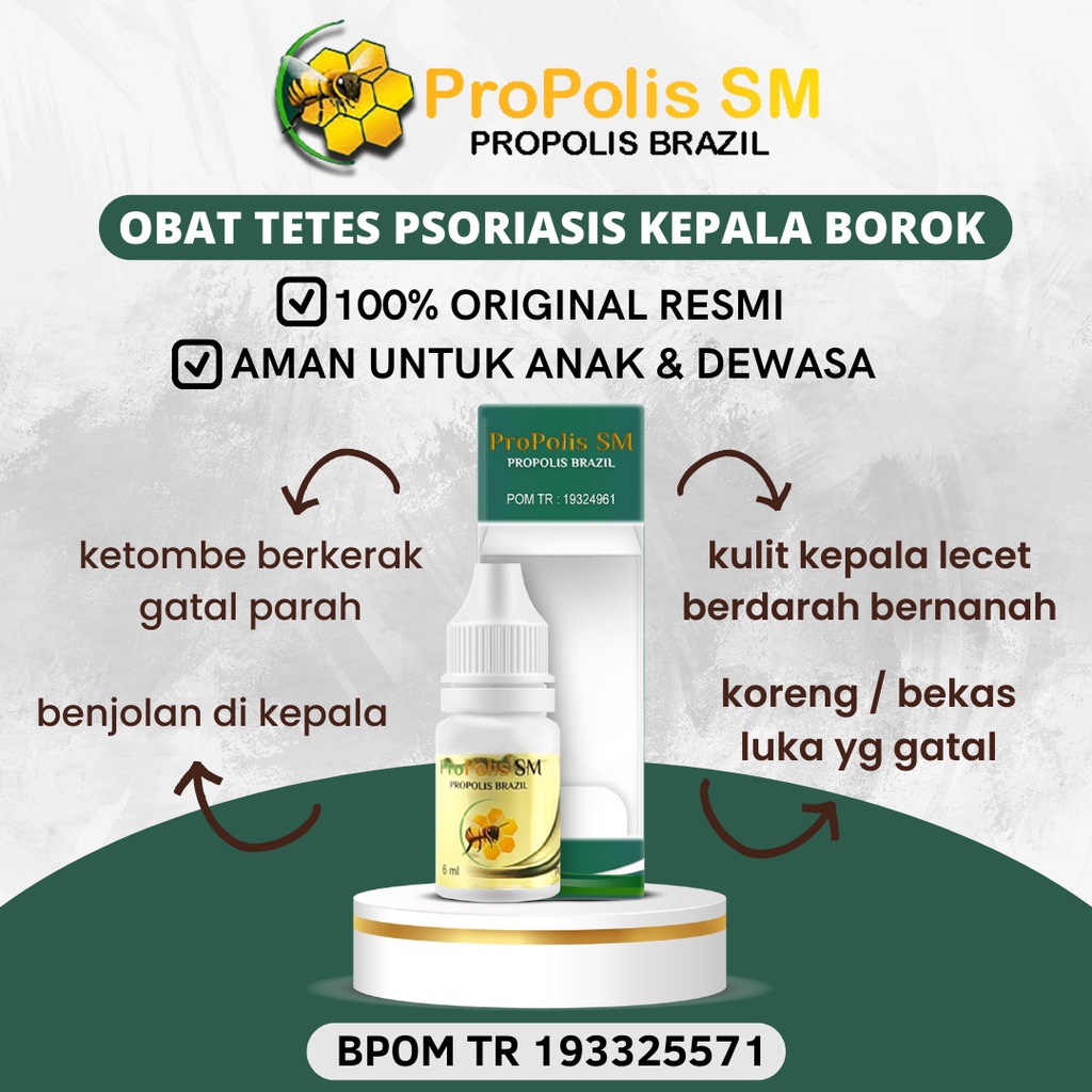 Jual Obat Tetes Psoriasis Kulit Kepala Borok Dermatitis Seboroik ...