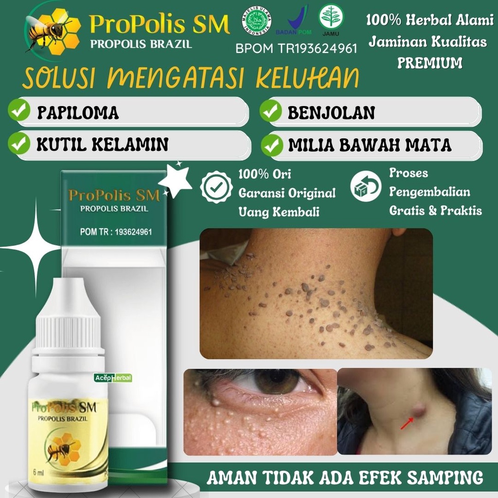 Jual Obat Papiloma Leher Penghilang Kutil Dan Tahi Lalat Obat Milia ...