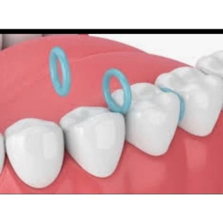 Jual karet separator/karet orthodontic | Shopee Indonesia