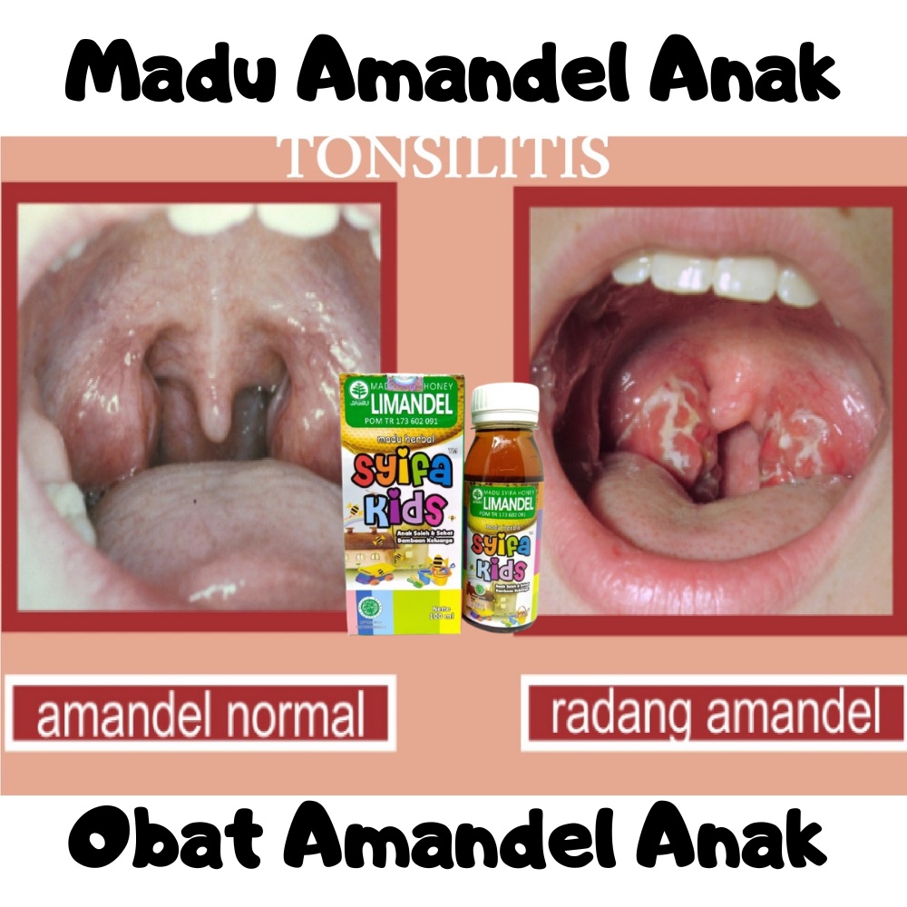 Jual Madu Amandel Anak Obat Radang Tenggorokan Sakit Amandel Tongsilitis | Shopee Indonesia