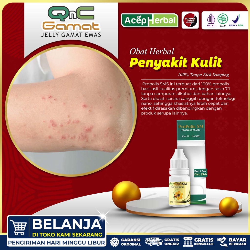Jual Obat Gatal Gatal Seluruh Badan Panu Psoriasis Obat Penyakit Kulit ...