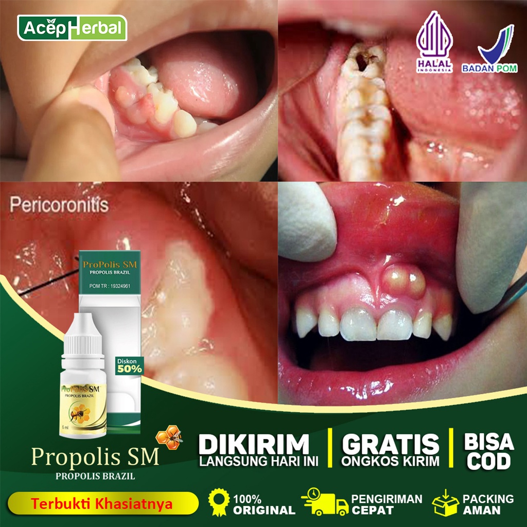 Jual Obat Gusi Bengkak Sakit Gigi Gigi Berlubang Radang Gusi Plak Gigi ...