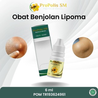 Jual Obat Benjolan Lipoma, Penghancur Benjolan di Tubuh, Benjolan Di ...