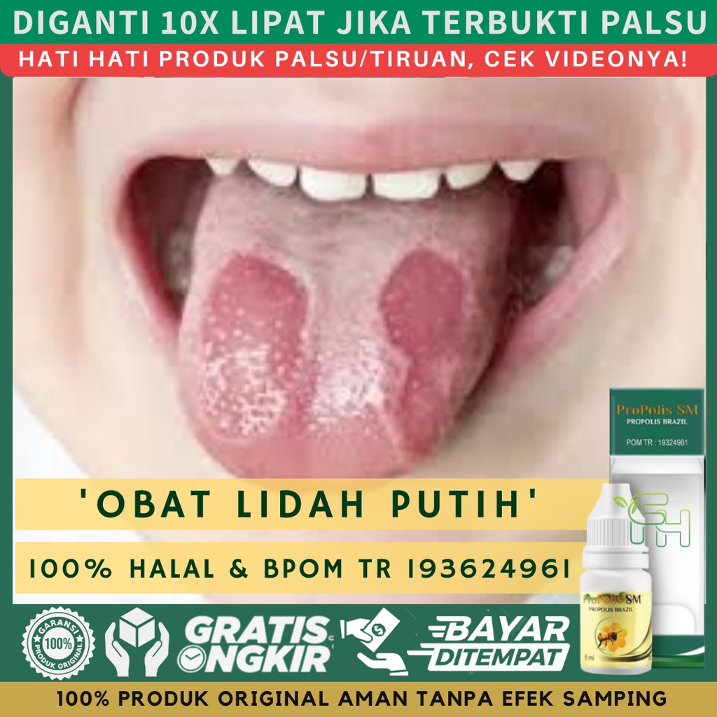 Jual Obat Lidah Putih - Obat Tetes Lidah Putih Pada Anak - Radang Lidah ...