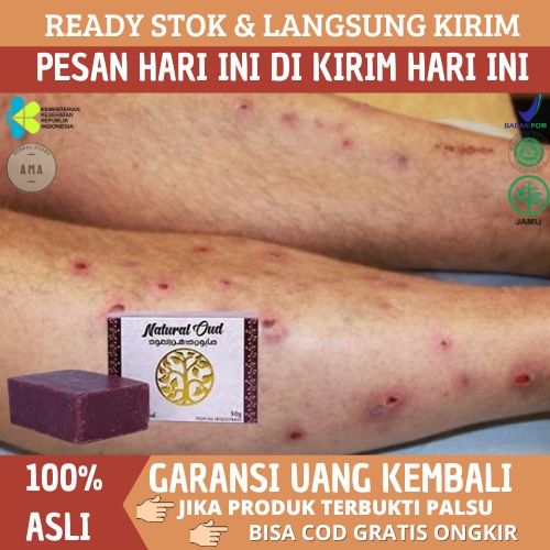 Jual Sabun Penghilang Koreng Di Kaki / Tangan, Penghilang Bekas Koreng ...