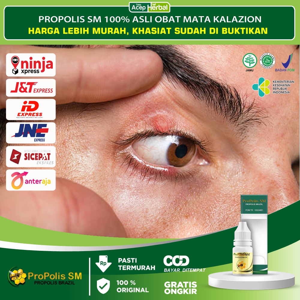 Jual Obat Mata Bintitan Kalazion Propolis SM Mata Bengkak Benjolan di ...