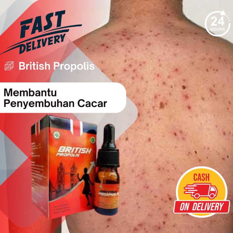 Jual British Propolis 6ml Cacar Air Monyet Biang Keringat Bintil Merah ...